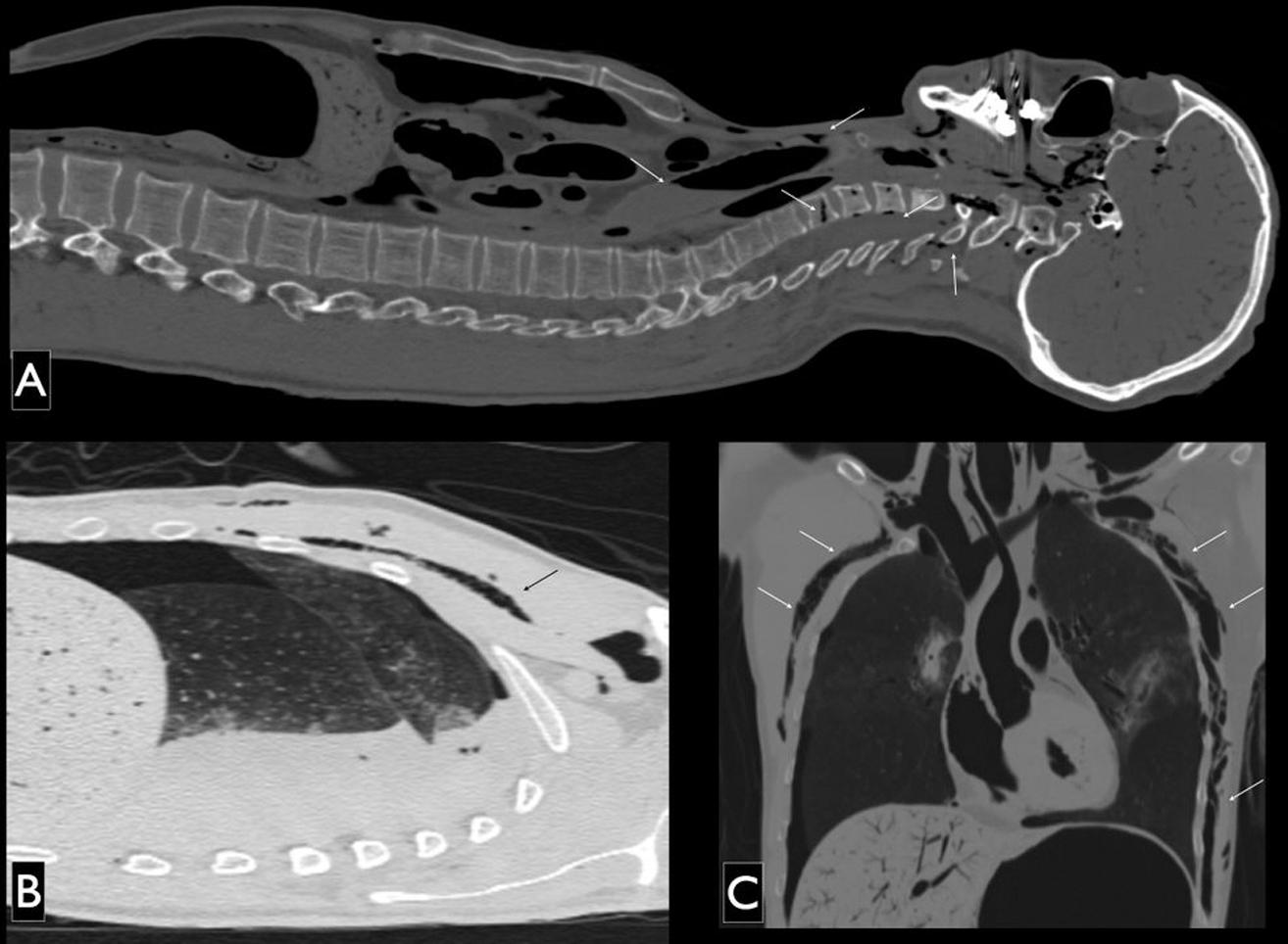 post-mortem CT (PMCT) imaging – Radiología Club