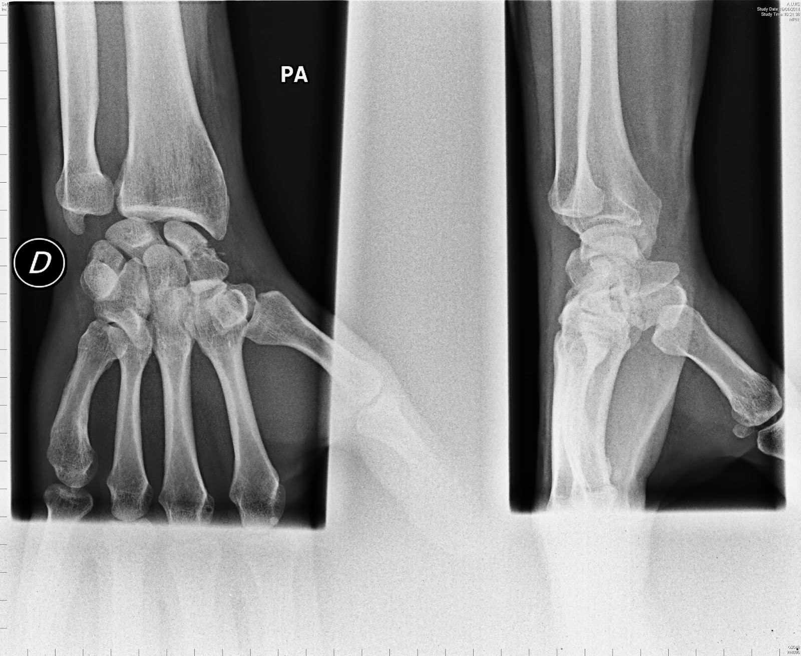 Radiodiagnóstico para el hueso escafoides – Radiología Club