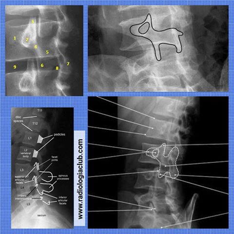 Signo Radiológico: ‘Perrito escocés’ o proyección de ‘La Chapelle ...